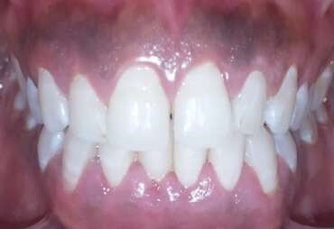 Depigmentation - Noida Dental Clinic